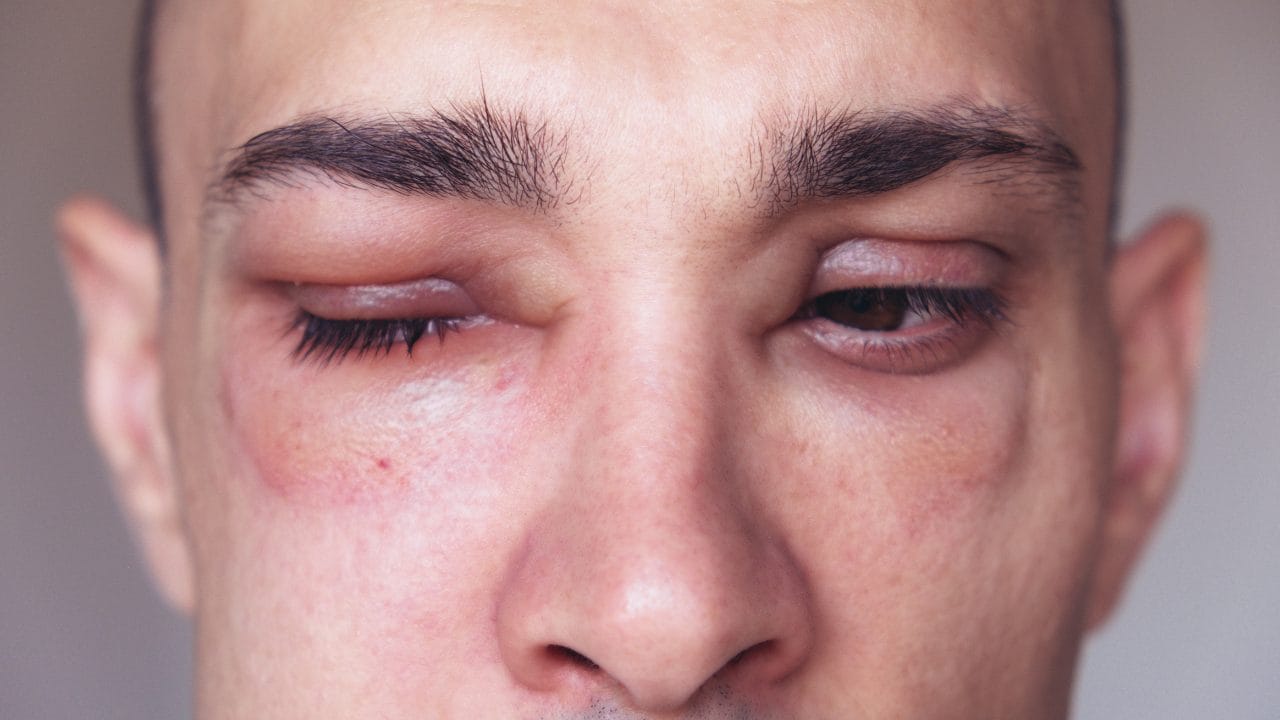 ¿Qué es la alergia y por qué se produce? | Eltiempo.es